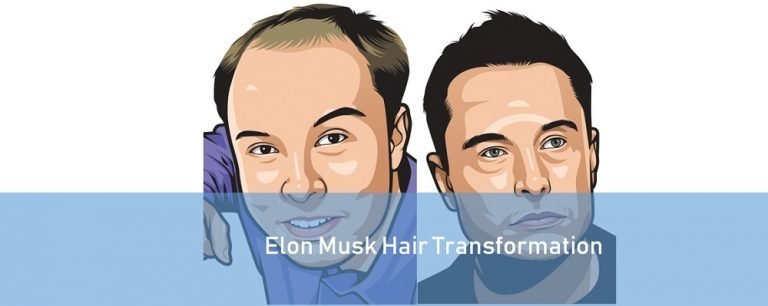 Elon Musk Hair Loss and Recovery Story [Transformation]